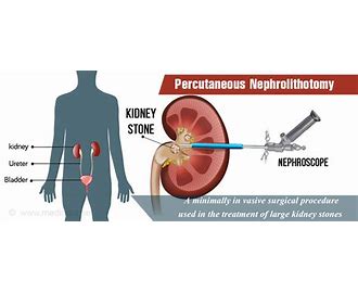 Stand for PCNL?